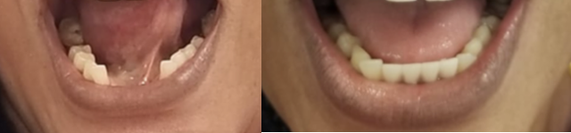 Replace Your Missing Teeth At-Home | ResetSmile